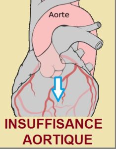 INSUFFISANCE AORTIQUE – Santé Médecine
