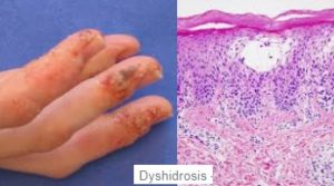 Dyshidrose – Santé Médecine