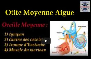 Otite moyenne aiguë – Santé Médecine