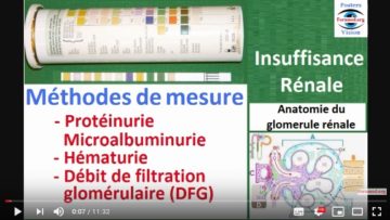 Protéinurie: 12 points à retenir – Santé Médecine