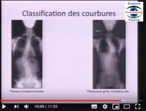 Les Causes de la Scoliose et Classification selon le bilan de ...