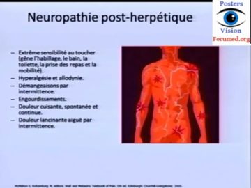 Conduite à tenir devant une douleur neuropathique – Santé Médecine