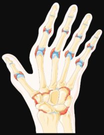La polyarthrite rhumatoïde – Santé Médecine