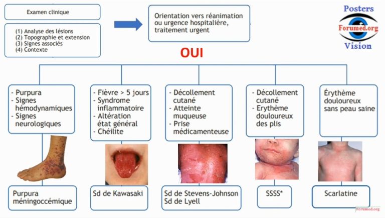 Fi vre ruptive S miologie ruption Erythemato Maculo Papuleuse Fi vre ruptive S miologie ruption Erythemato Maculo Papuleuse