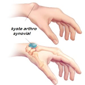 kyste arthro synovial du Poignet – Santé Médecine