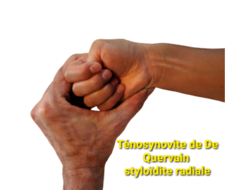 Ténosynovite de De Quervain styloïdite radiale – Santé Médecine
