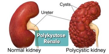 La polykystose rénale autosomique dominante – Santé Médecine