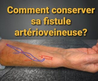 Comment conserver sa fistule artérioveineuse? – Santé Médecine