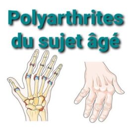 Polyarthrites du sujet âgé – Santé Médecine