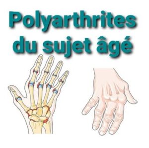 Polyarthrites du sujet âgé – Santé Médecine