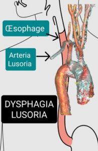 DYSPHAGIA LUSORIA – Santé Médecine