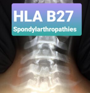 HLA-B27 et Spondyloarthropathie SPA – Santé Médecine